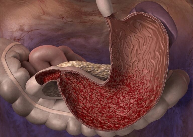 Gastritis in Connecticut - Connecticut GI